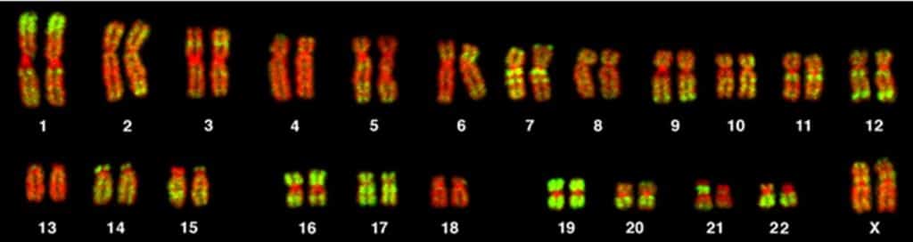 trisomy karyotype example